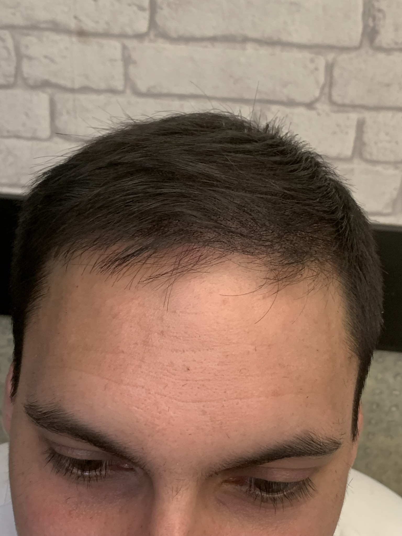 Hairline Tattoo Trending in 2021-22 - Hair Tattoo, Clinics in London ...